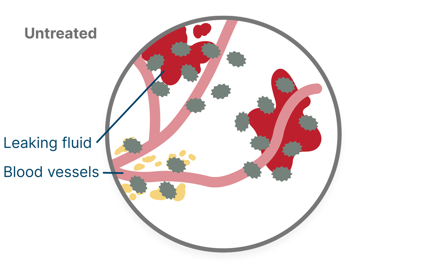Why EYLEA HD for Treatment of Wet AMD, DME, & DR | EYLEA HD
